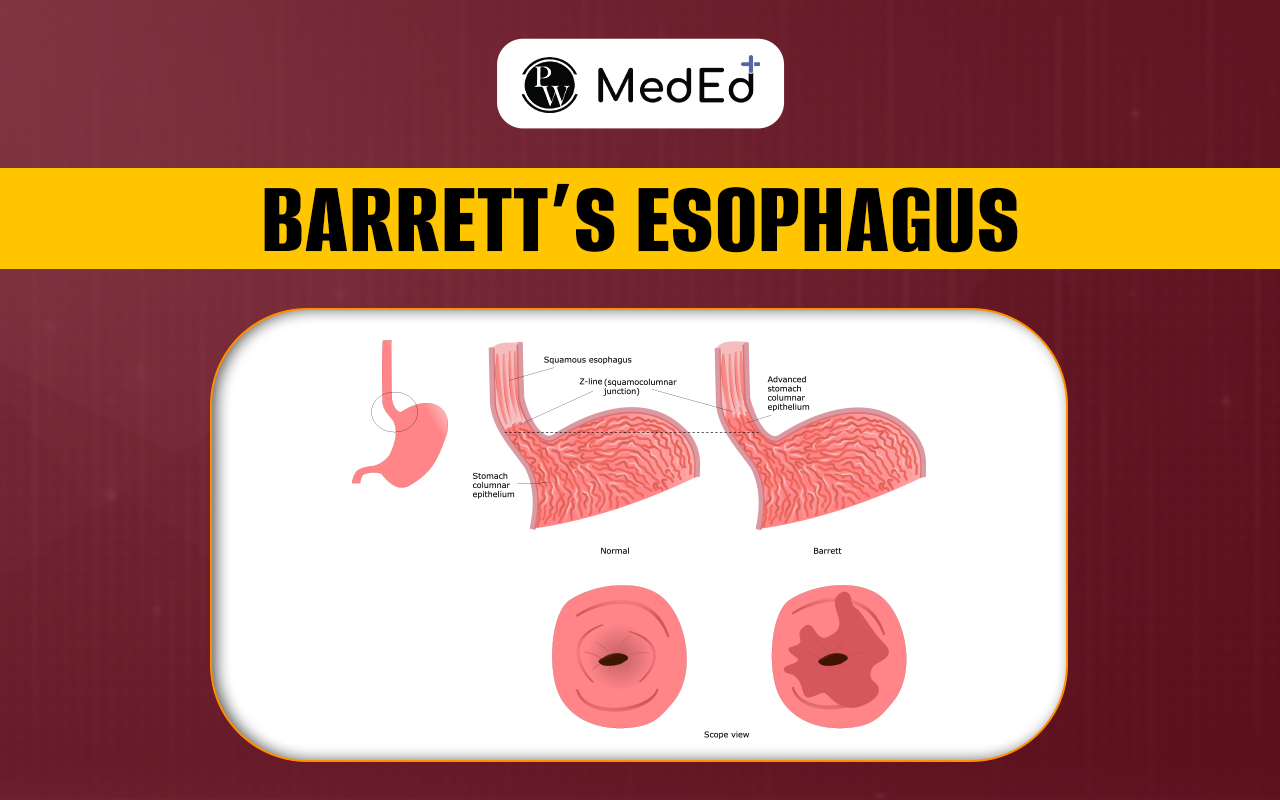 Barrett's Esophagus, Risk Factors, Symptoms