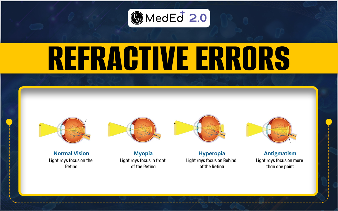 Refractive Errors Causes, Types, And Treatment Process Refractive Errors Causes, Types, And Treatment Process
